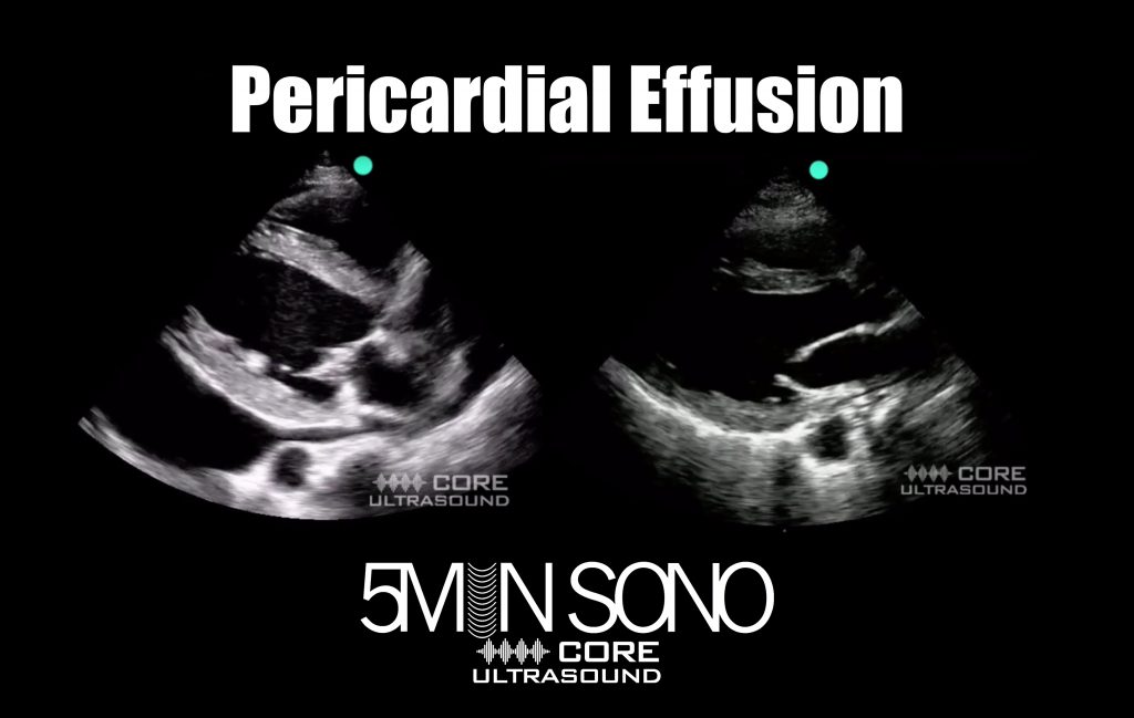 Pericardial Effusion – Core Ultrasound