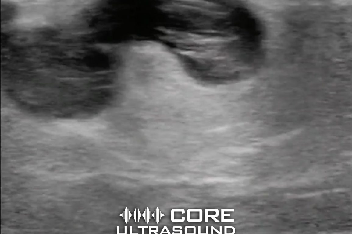 DVT – Core Ultrasound