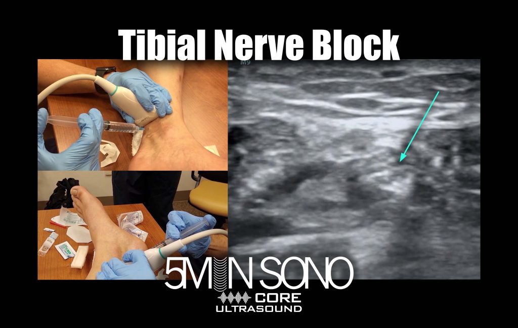 Posterior Tibial Nerve Block – Core Ultrasound
