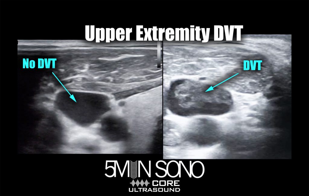 5 Minute Sono Upper Extremity DVT Core Ultrasound