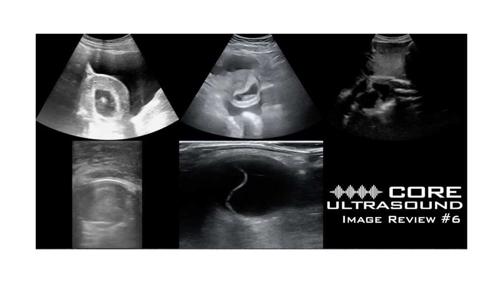 Core Ultrasound Image Review, Episode 6! – Core Ultrasound