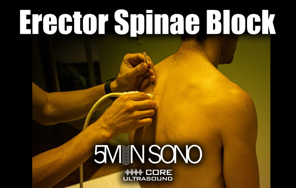 5 Minute Sono – Erector Spinae Block – Core Ultrasound