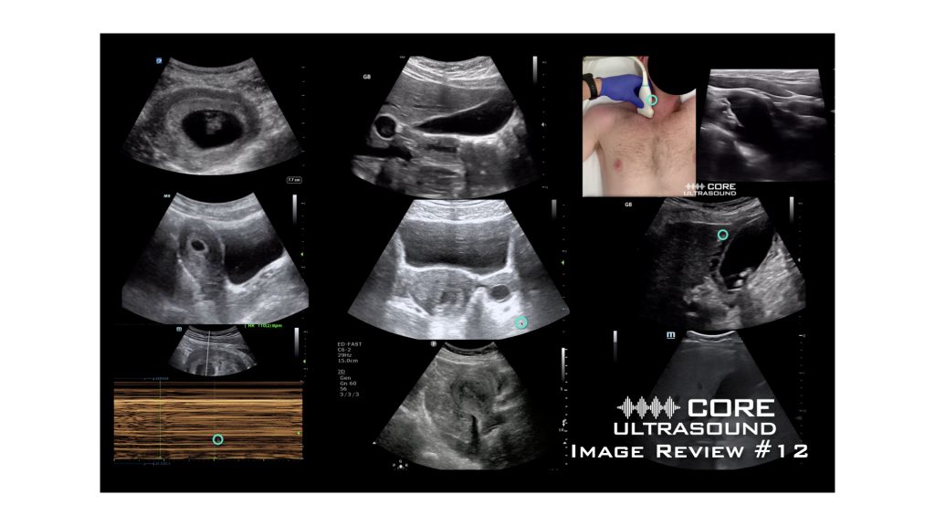 Core Ultrasound Image Review #12 – Core Ultrasound