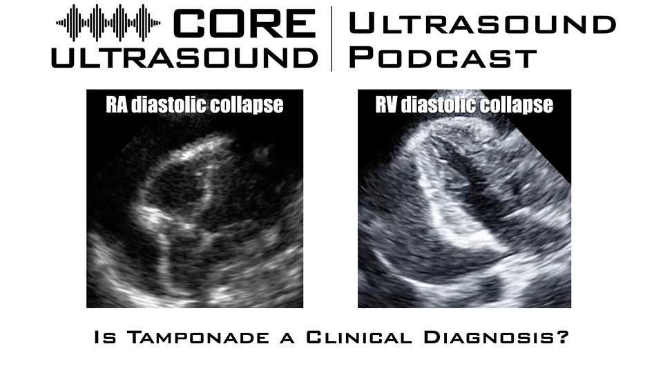 Is tamponade a clinical diagnosis? – Core Ultrasound