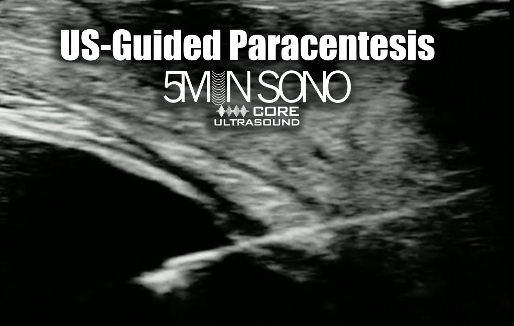 Paracentesis – Core Ultrasound