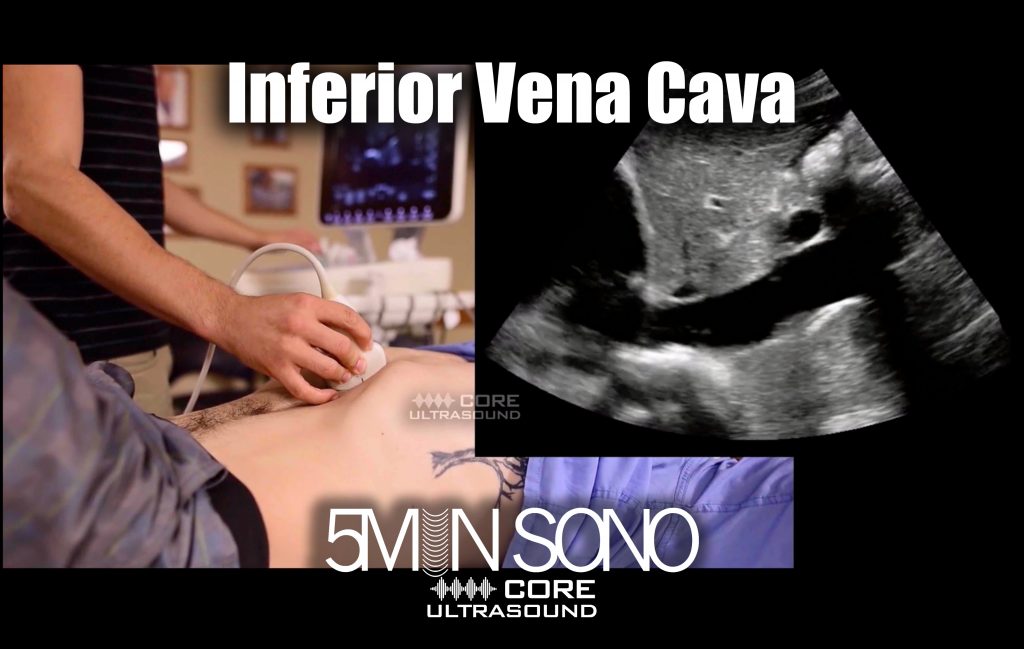 IVC (2021) – Core Ultrasound