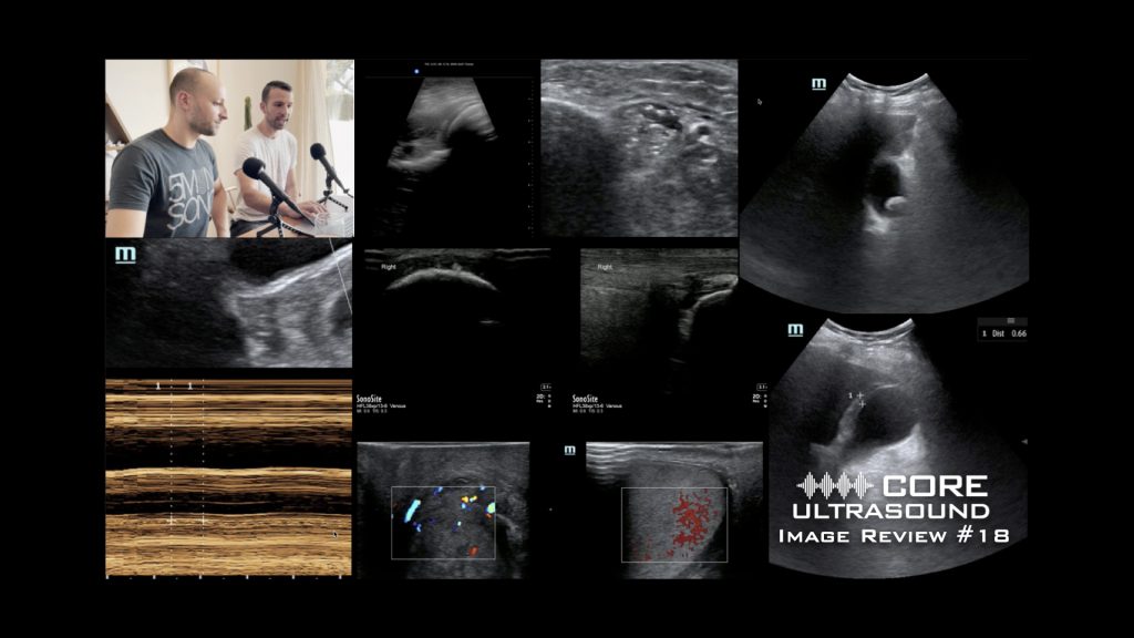Core Ultrasound Image Review, Episode 18! – Core Ultrasound