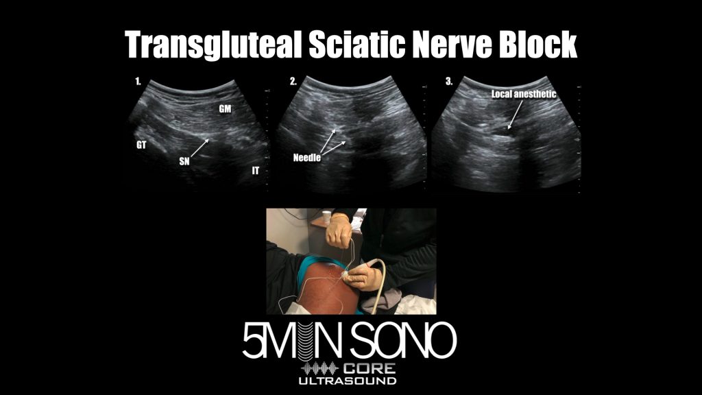 5 Min Sono – Transgluteal Sciatic Nerve Block – Core Ultrasound