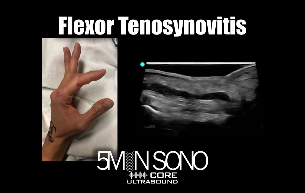 Flexor tenosynovitis – Core Ultrasound