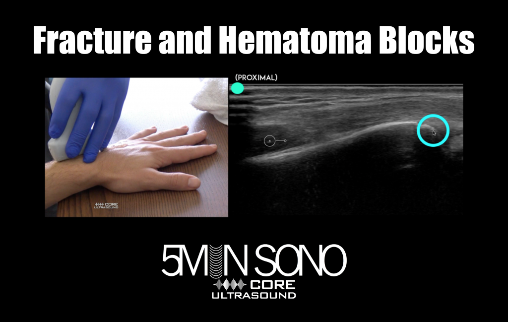 Fracture identification and Hematoma blocks – Core Ultrasound